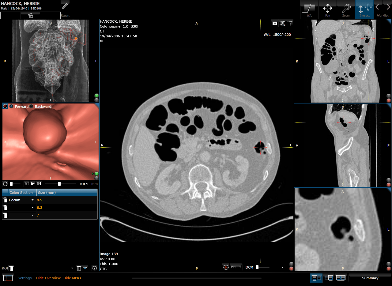CT Colonography -3Dnet CT Colonography -3Dnet